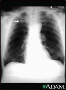 TB – Chest X-Rays | DiagnosisDude
